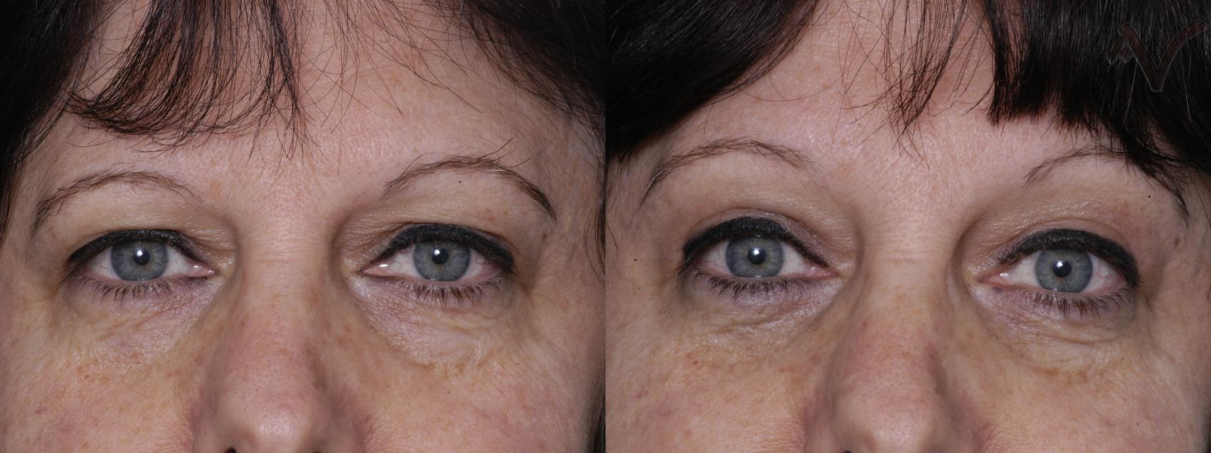 Lower Blepharoplasty Gone Wrong