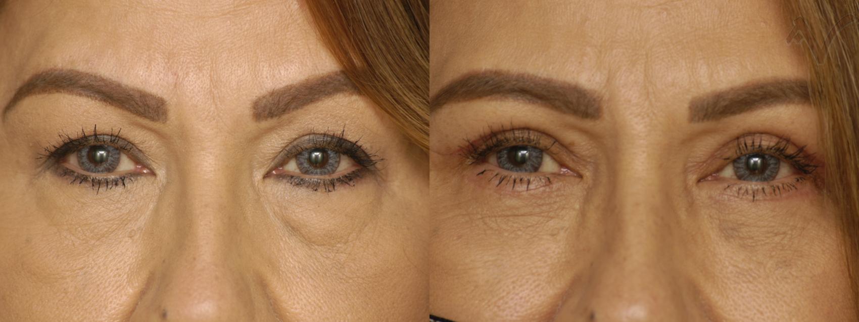 Combined Upper & Lower Eyelid Surgery Before and After Pictures Case ...
