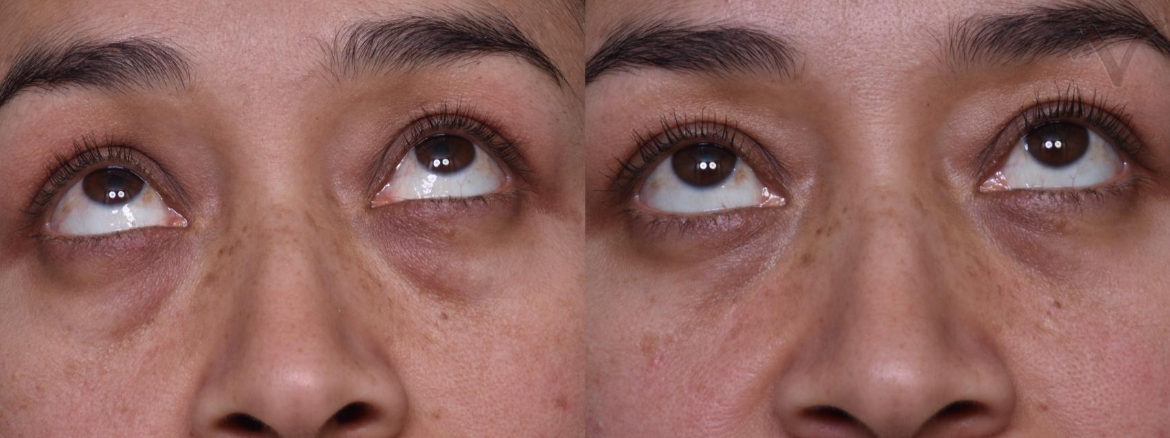 Lower Eyelid Surgery Before and After Pictures Case 378 | Los Angeles ...